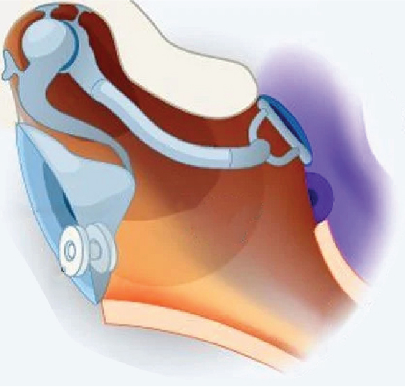 Best Myringotomy Surgery in Dubai | Dr. Mustafa Kapadia